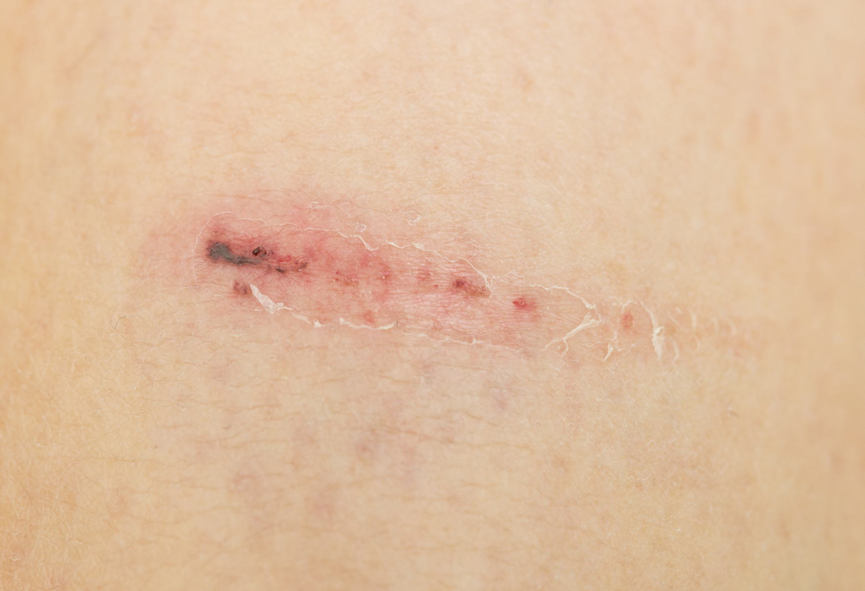 Miten haava paranee?