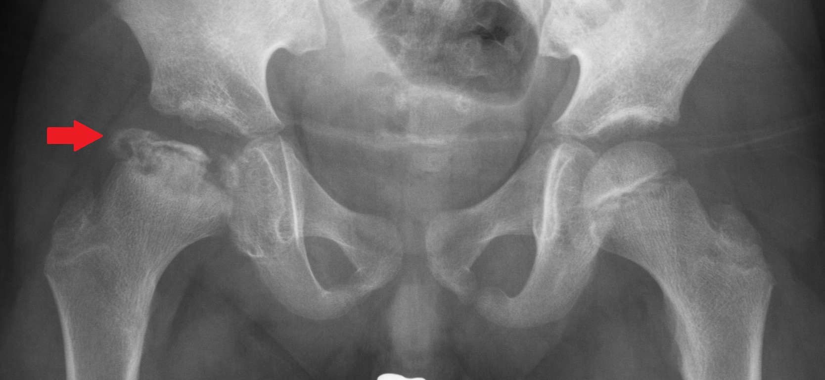 Legg-Calvé-Perthes sjukdom