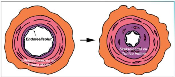Om pulmonell hypertoni