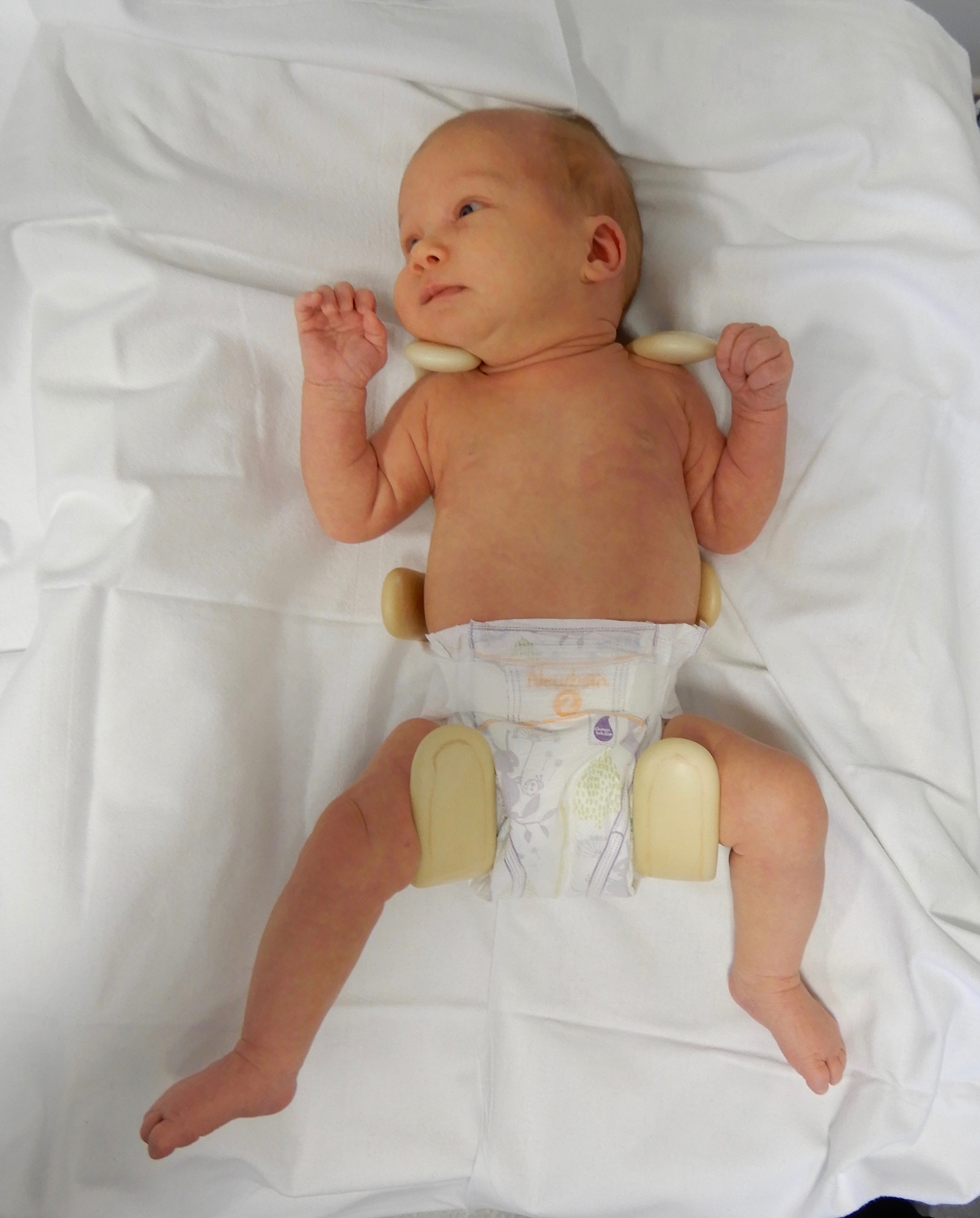 Synnynnäinen lonkkanivelen sijoiltaanmeno