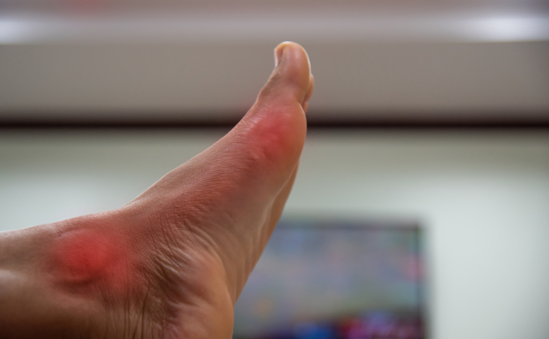 Kihtikohtaus ja kihdin diagnoosi