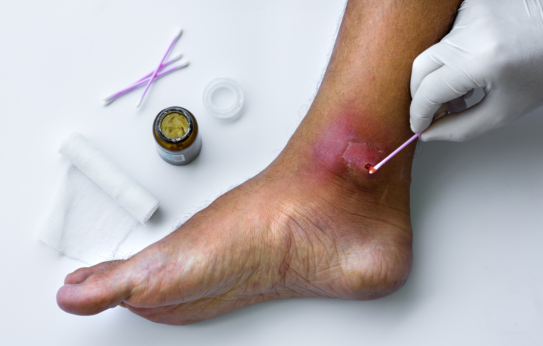 Infektion i det akuta såret