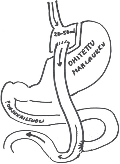 Mahalaukun ohitusleikkaus