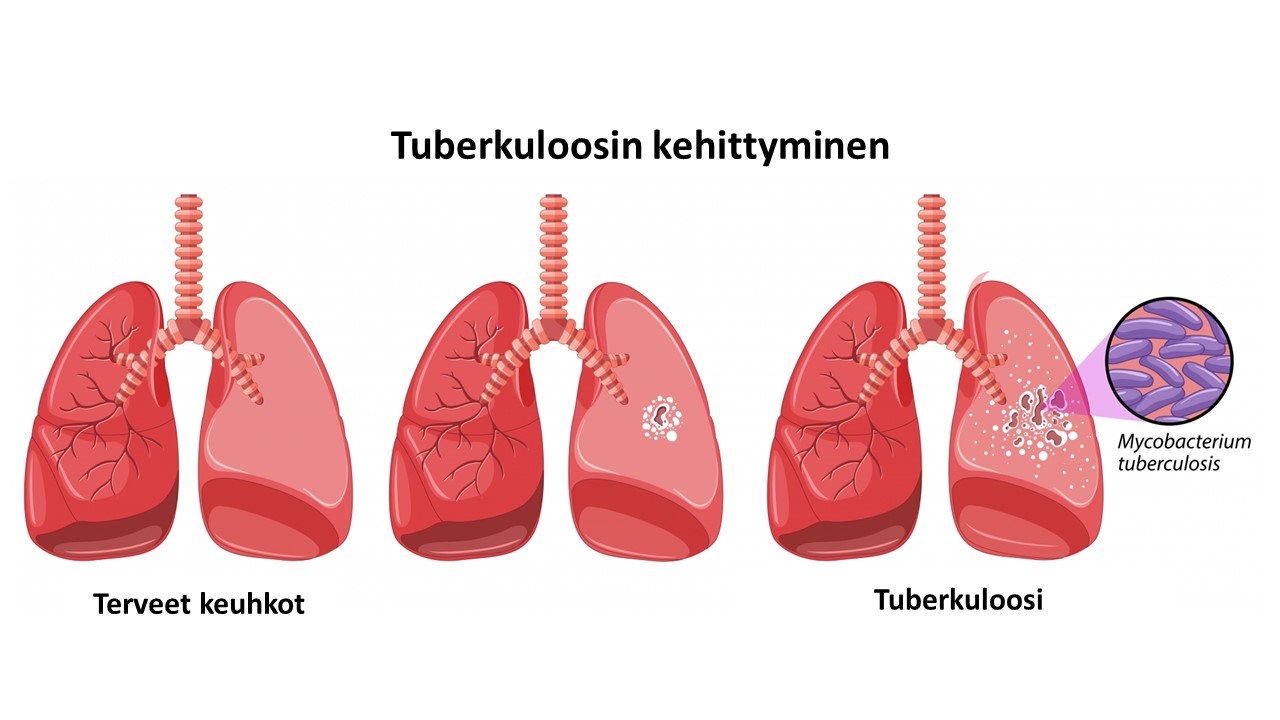 Tuberkuloosi