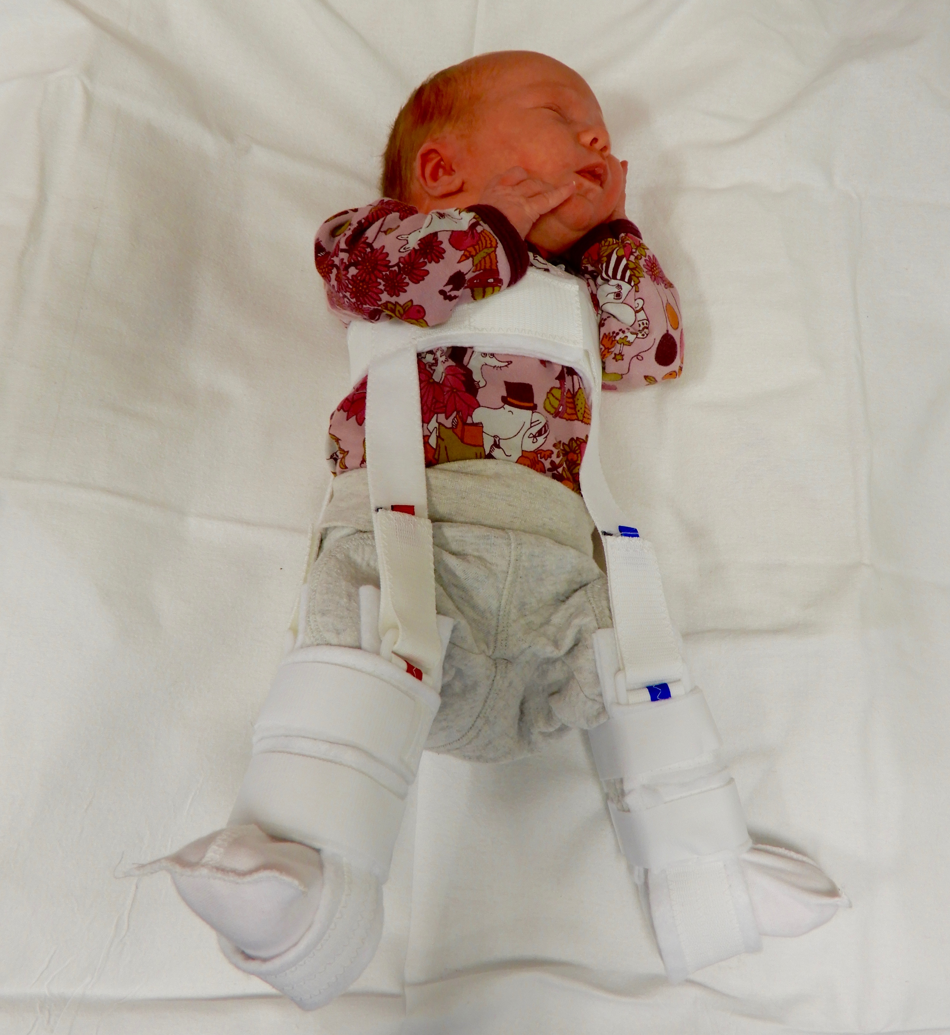 Synnynnäinen lonkkanivelen sijoiltaanmeno