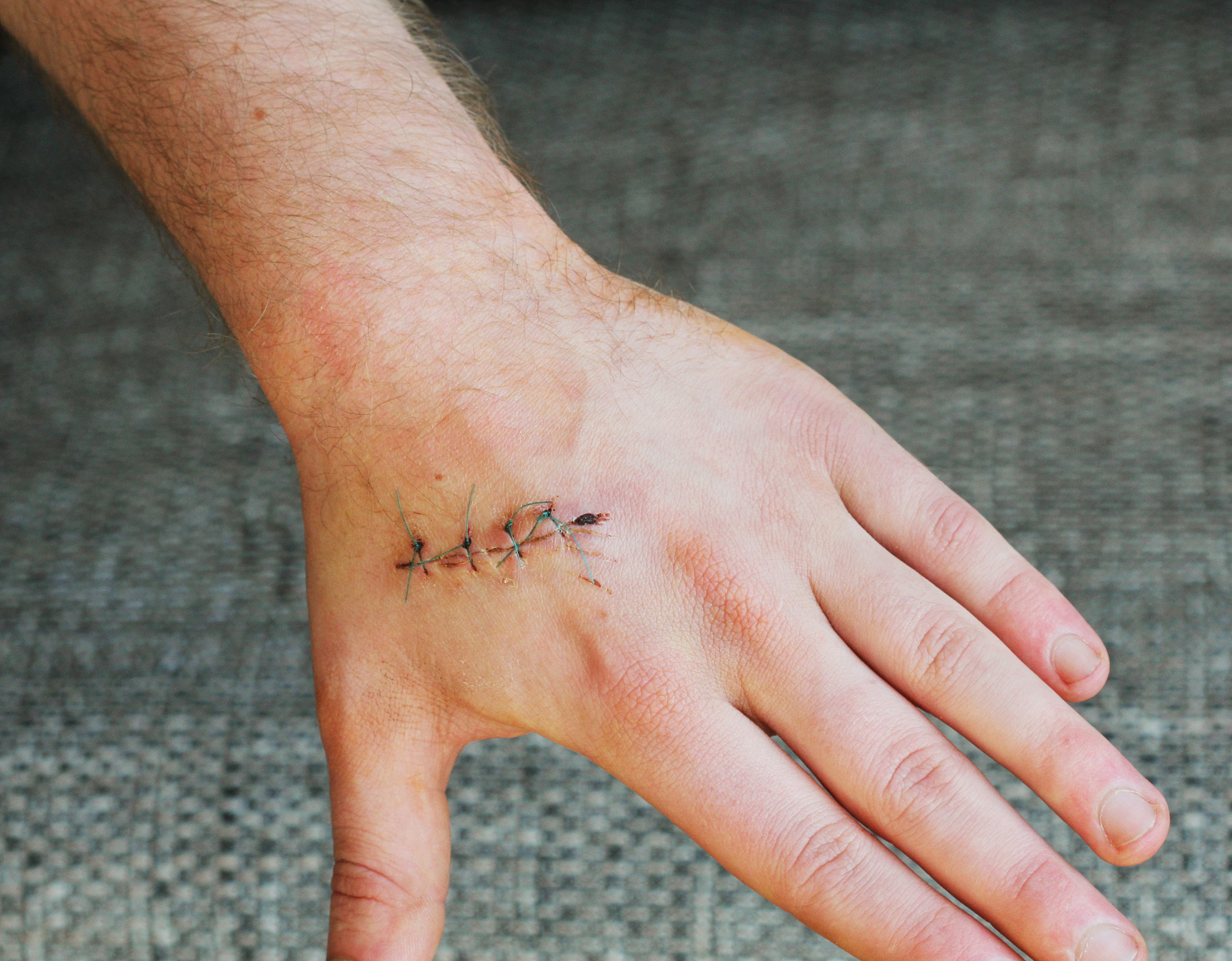 Miten haava paranee?