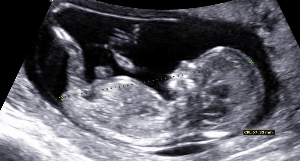 Allmän ultraljudsundersökning och kombinerad screeningundersökning ...